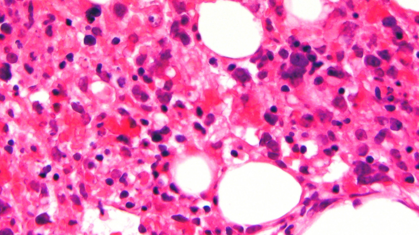 How Painful Is A Bone Marrow Biopsy Can You Be Sedated How Painful Is A Bone Marrow Biopsy Can You Be Sedated