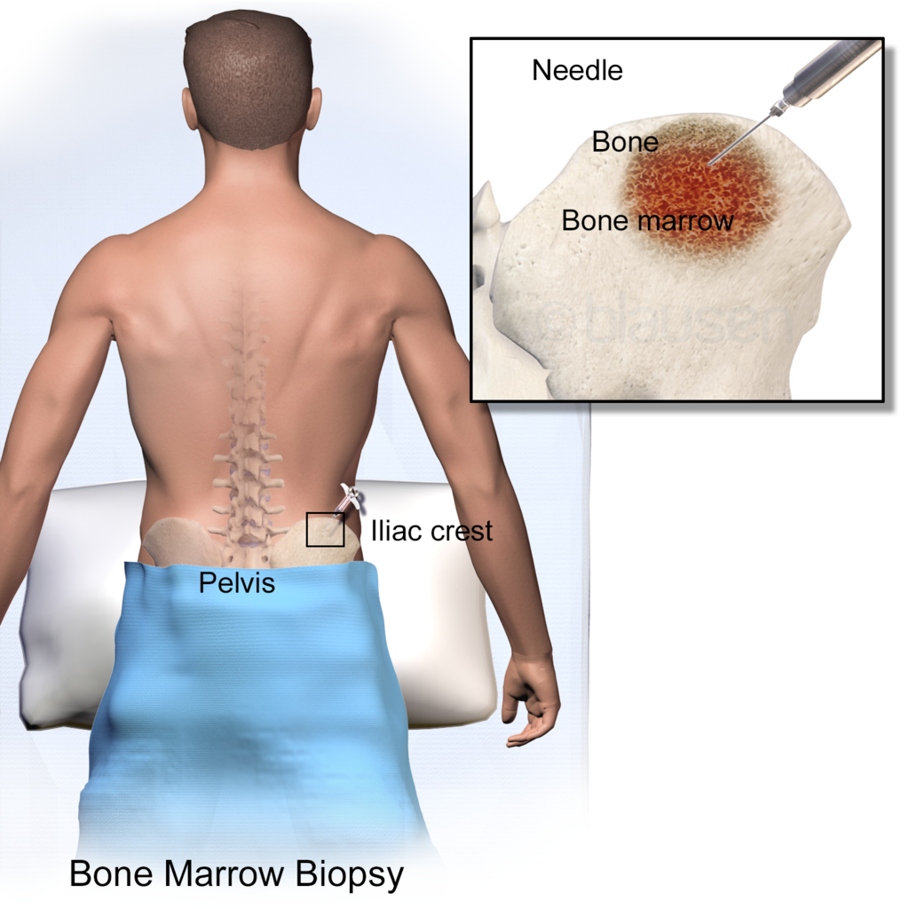 How Painful Is A Bone Marrow Biopsy Can You Be Sedated How Painful Is A Bone Marrow Biopsy Can You Be Sedated